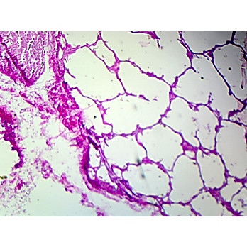 Prepared Microscope Slide,Lung of Smoker, Section Human