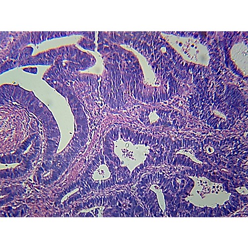 Prepared Microscope Slide,Adenocarcinoma of the Colon, Human